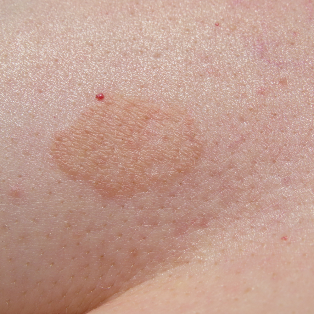 Gljivična infekcija kože